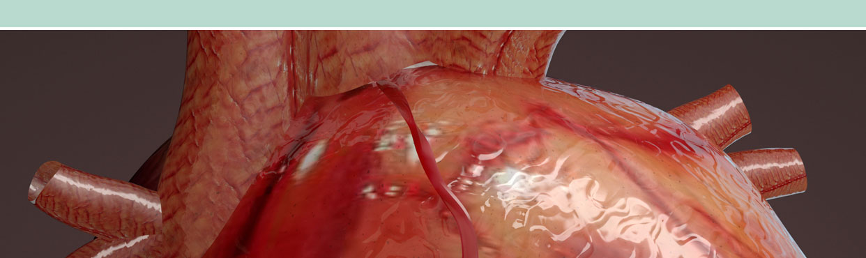 XyloCor – Gene therapy for advanced coronary artery disease